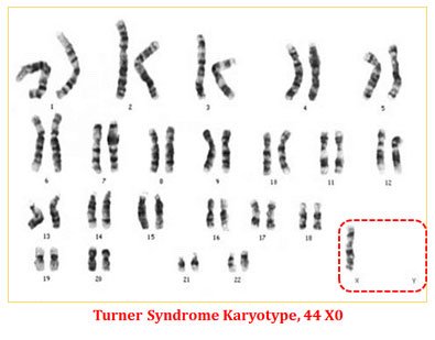 Karyotype Analysis of Human Chromosome | EasyBiologyClass